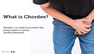 Understanding Chordee Repair: A Comprehensive Guide to Treatment and ...